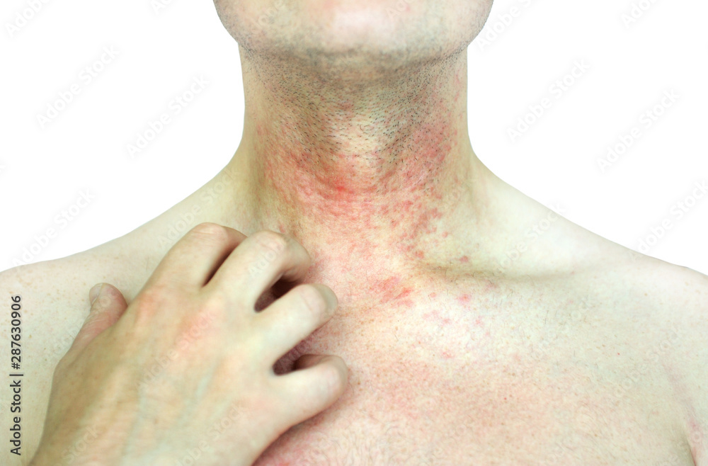 Atopic dermatitis (AD), also known as atopic eczema, is a type of skin ...