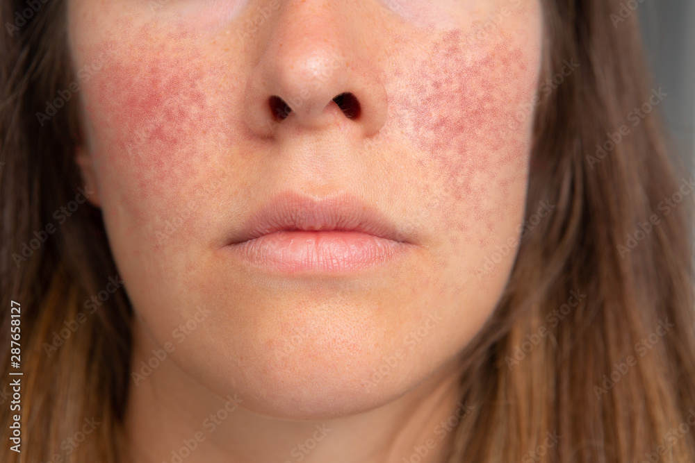 A closeup view on the lower face area of a thirty year old caucasian ...