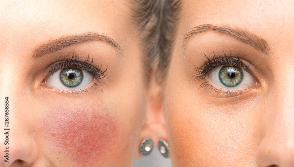Before and after results of Brimonidine tartrate treatment for rosacea ...