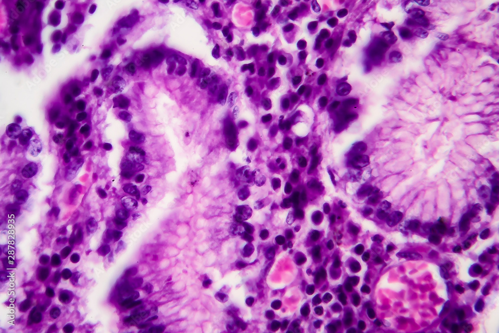 Histopathology of stomach adenocarcinoma, light micrograph, photo under ...