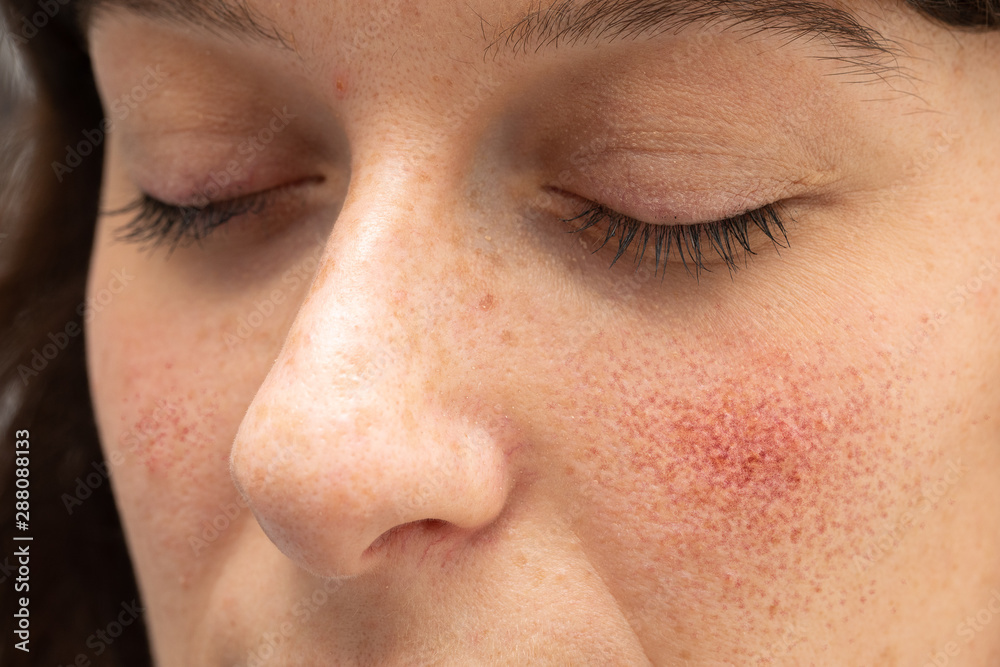 Problematic skin of a young caucasian woman is seen up-close. Red ...