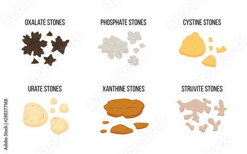 Kidneys stones types. Flat vector illustration: oxalate stones ...