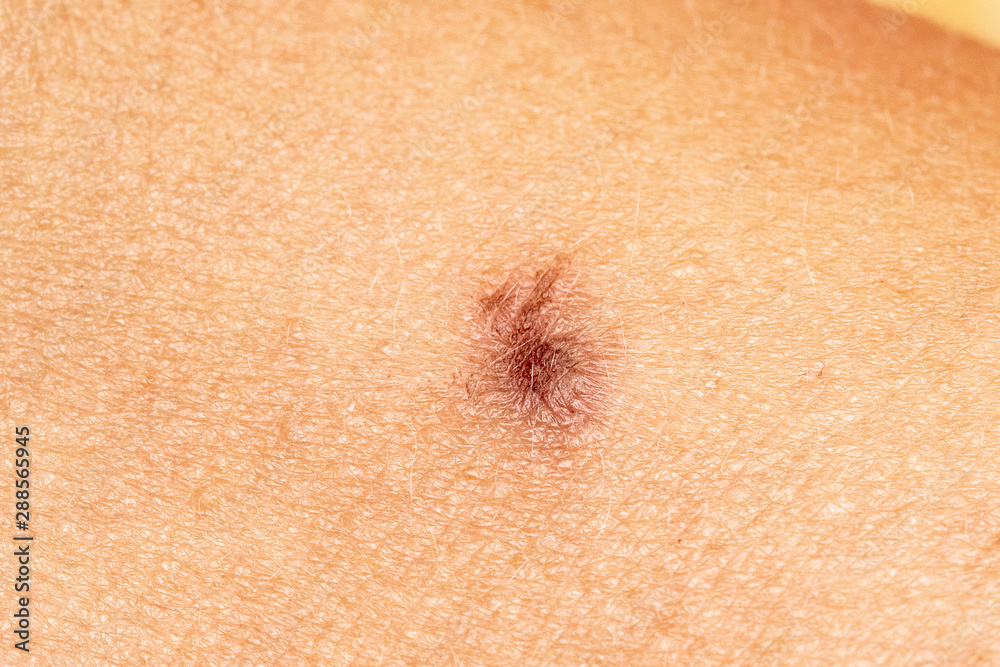 A closeup view on a brown mole on the skin of a human, with uneven ...
