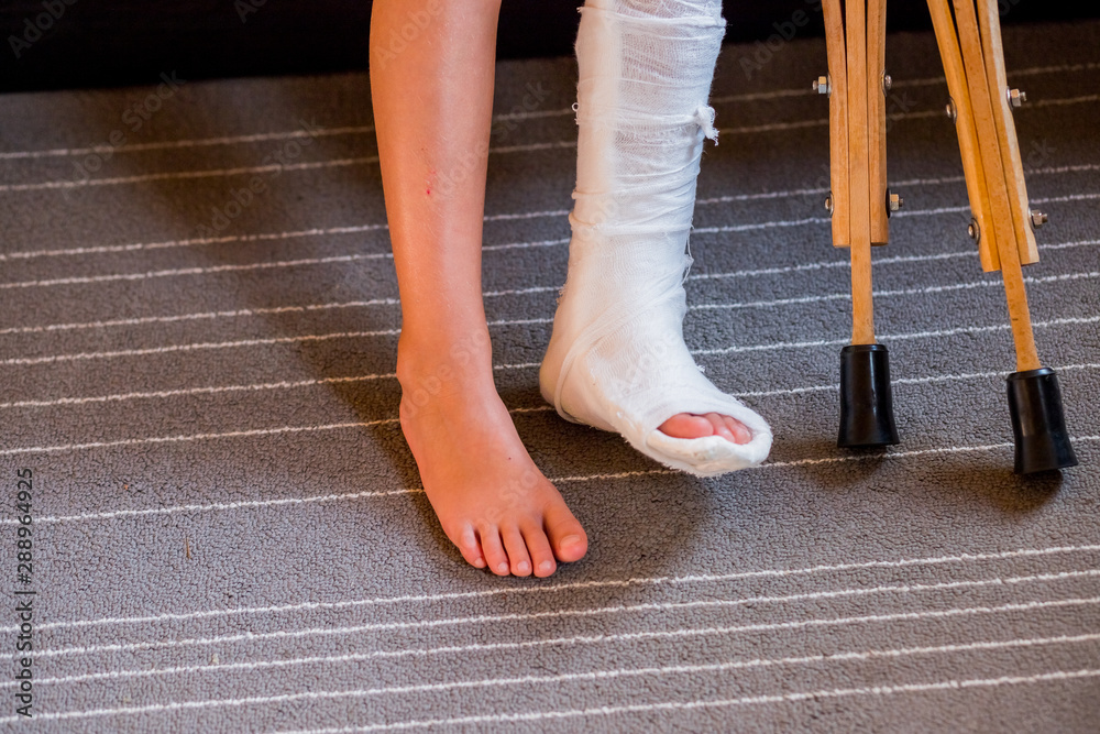 girl with a broken leg .close-up of feet, one with a plaster bandage ...