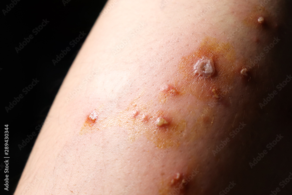 Blisters Purulent wounds Inflammation Allergic on the skin leg of women ...