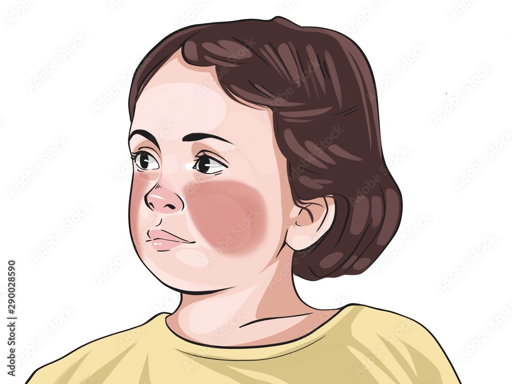 Scarlet fever is a disease which can occur as a result of a group A ...