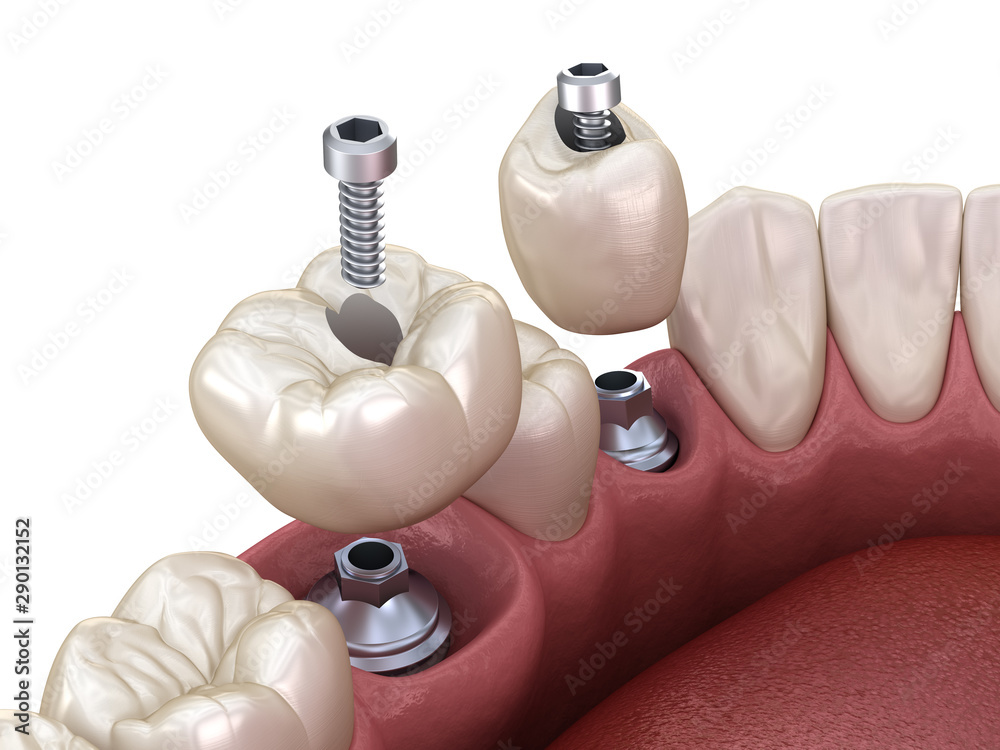 Premolar and Molar tooth crown installation over implant, screw ...