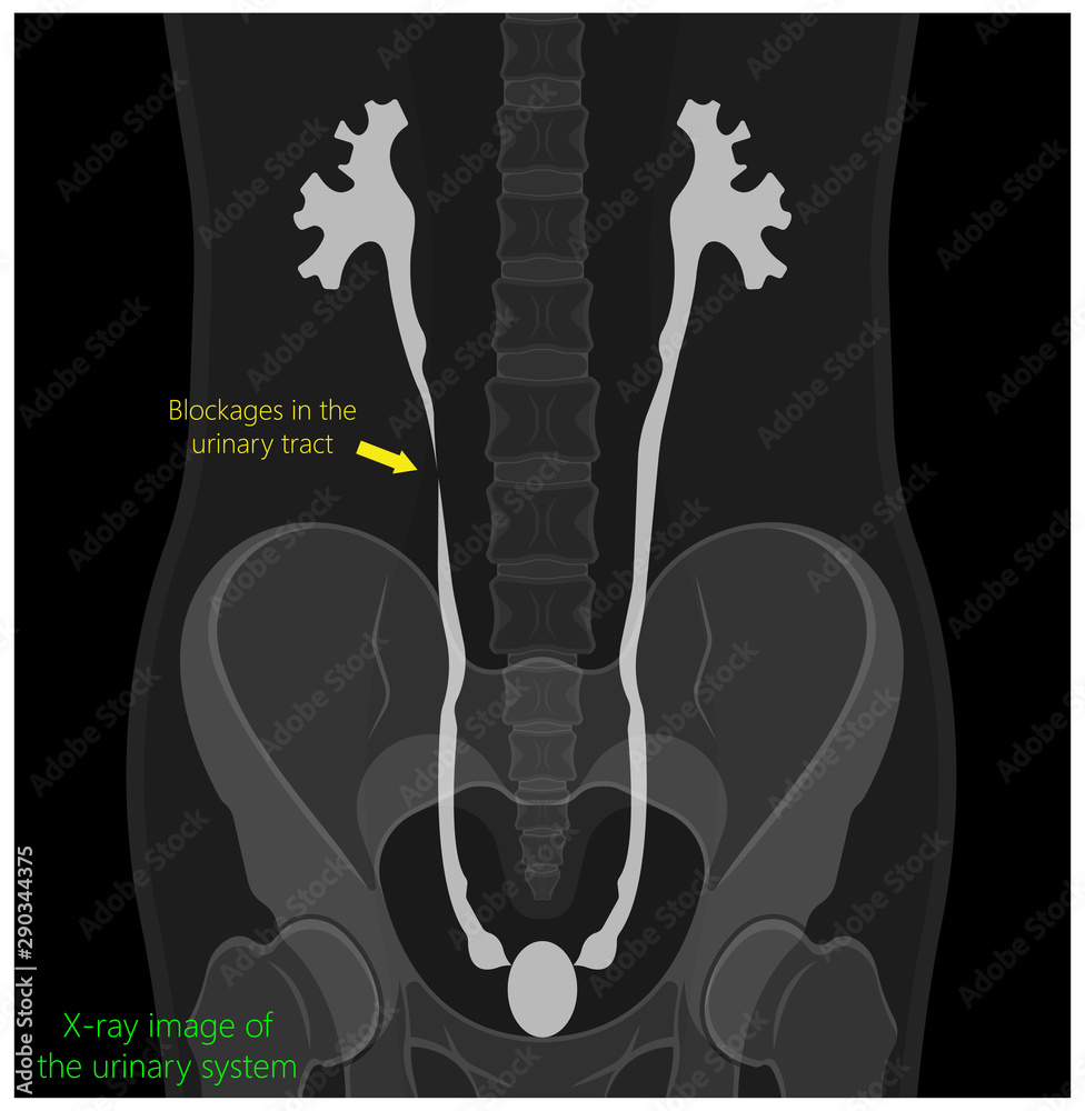 Intravenous pyelogram IVP examination x-ray for bladder kidney ureters ...