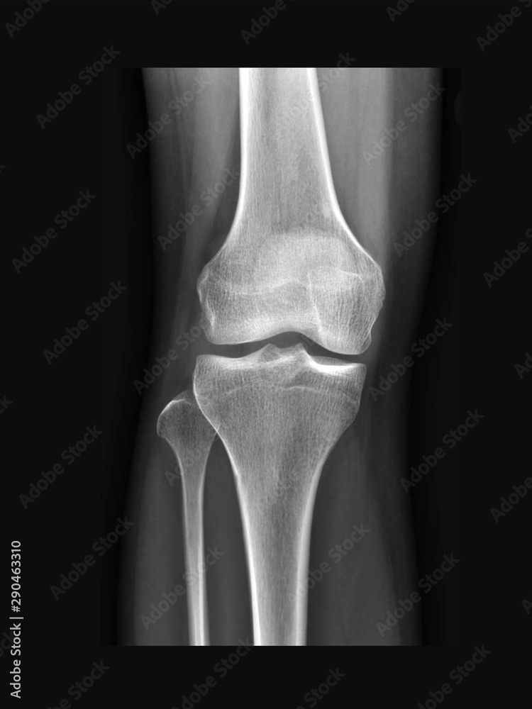 Film knee x-ray radiograph show normal human anatomy of knee, leg ...