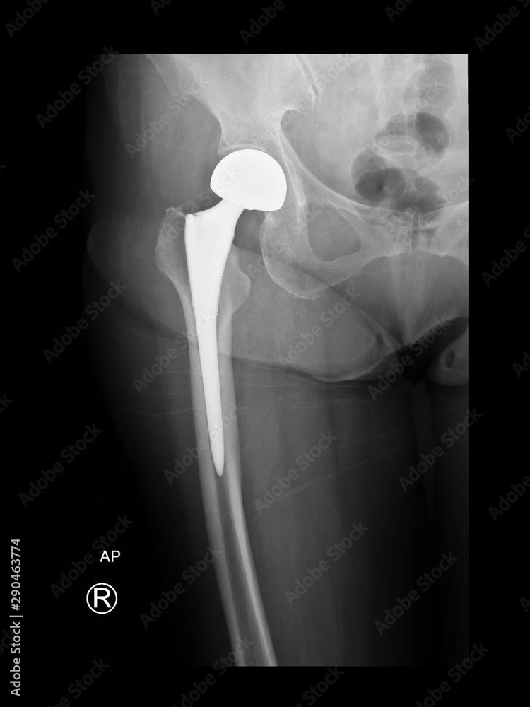 film X ray hip radiograph showing broken bone (fracture femur ) treated ...