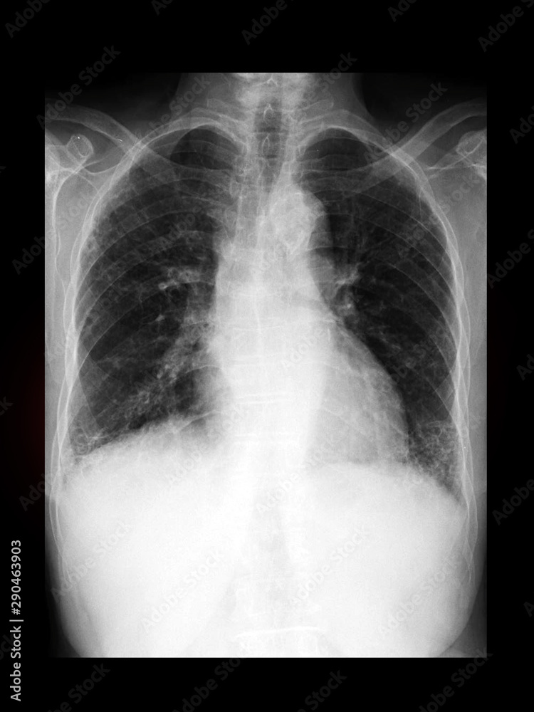film x-ray chest radiograph (CXR) show enlargement of lung 's airways ...