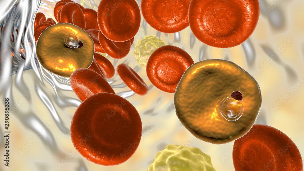 Red blood cells infected with malaria parasite Plasmodium vivax, ring ...