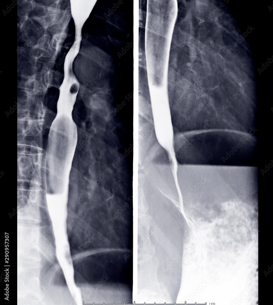 Esophagram or Barium swallow AP view Compare afterThe patient drinks a ...