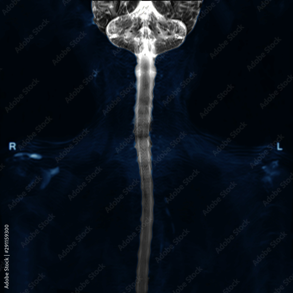 Stock-Foto „MRI of cervical spine use technique myelogram on Coronal ...
