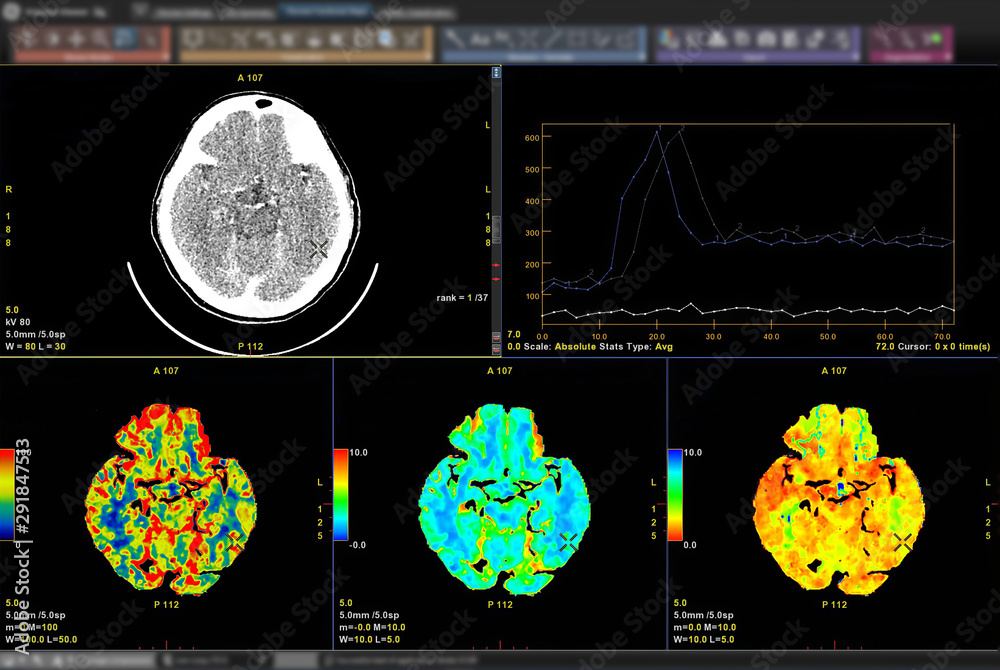 Perfusion CT scan image of the brain 3d rendering image analysing on ...