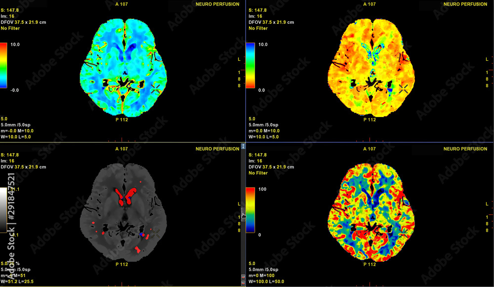 CT Brain Perfusion or CT scan image of the brain 3d rendering image ...