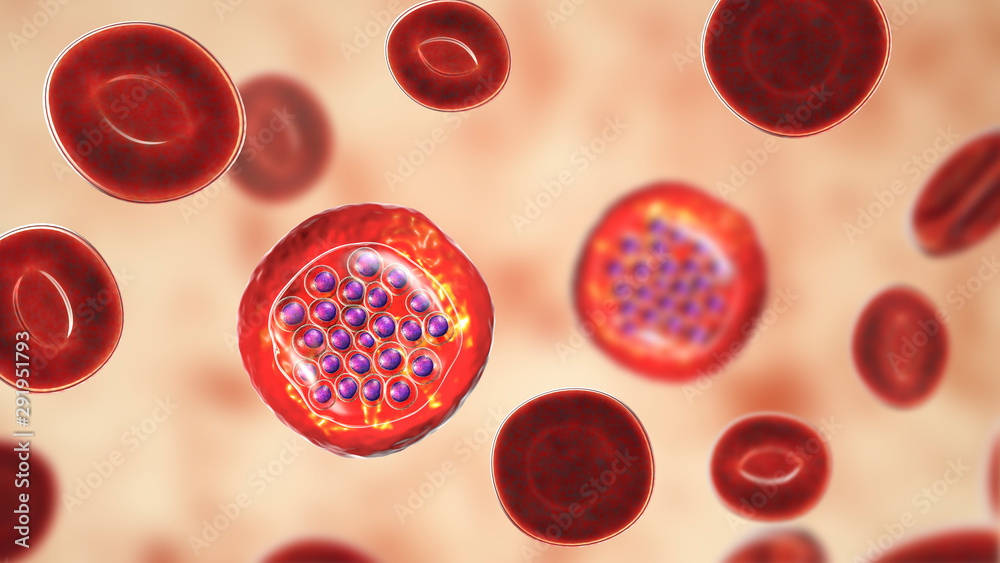 The malaria-infected red blood cells. 3D illustration showing malaria ...
