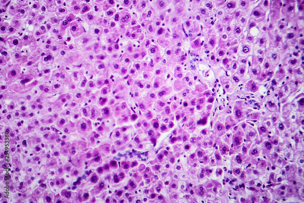 Cloudy swelling of the liver, light micrograph, photo under microscope ...