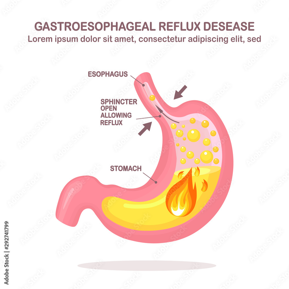 Human stomach. Gastroesophageal reflux disease. GERD, heartburn ...