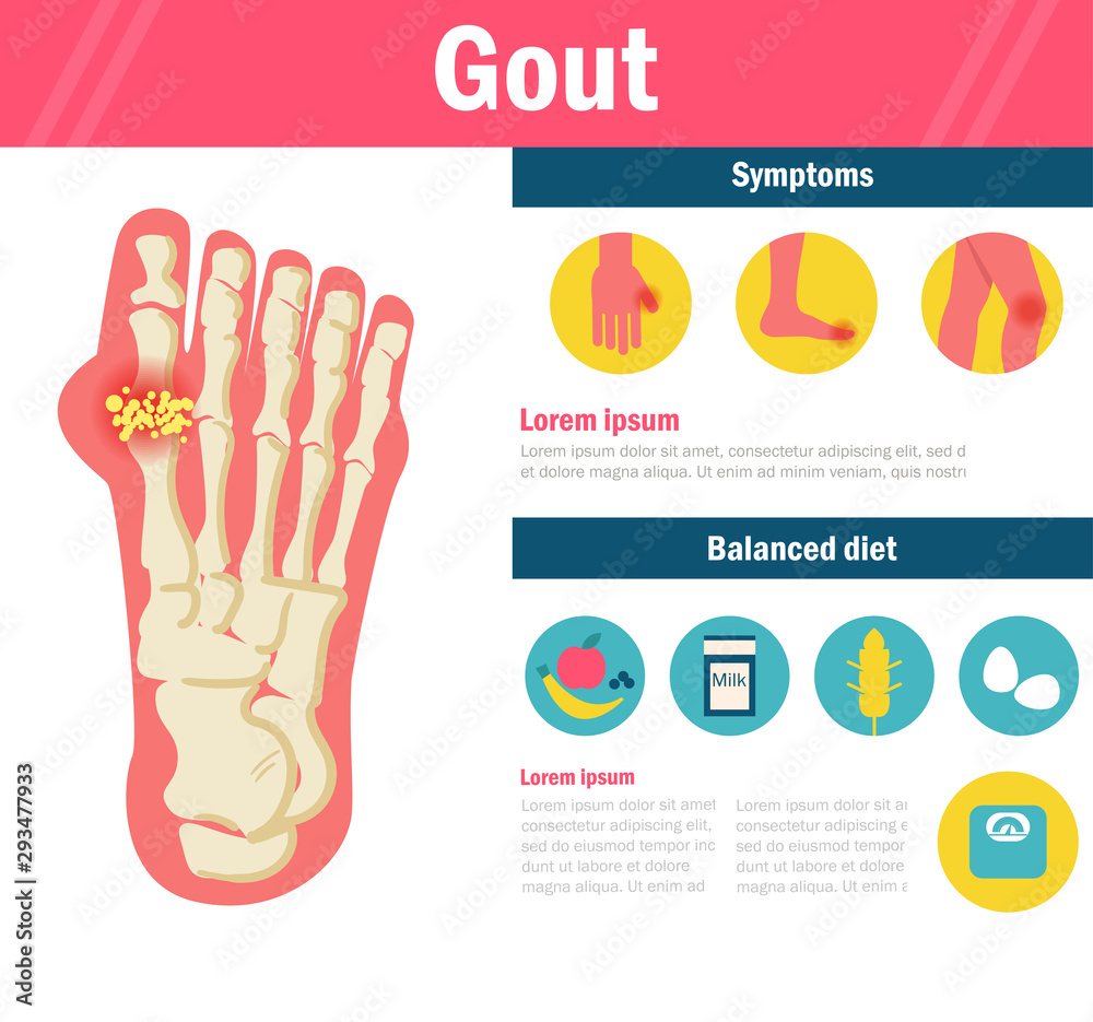 Gout Vector. Cartoon. Isolated art on white background. 素材庫向量圖 | Adobe ...