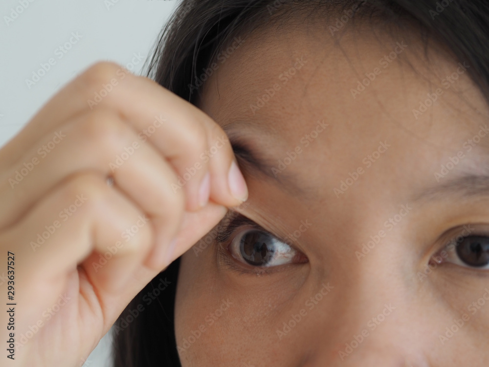 Foto de Stock exophthalmos or bulging eyes in woman. have eyeball protrudes from the eye socket ...