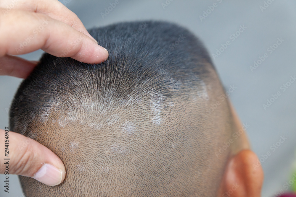 Close-up skin head , scalp, photos of dermatitis and eczema, skin ...