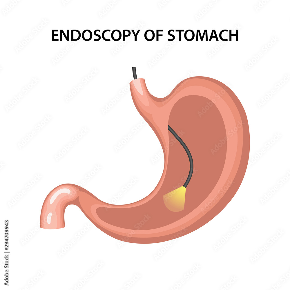 Endoscopy diagnostic of human stomach. Human stomach with endoscope ...