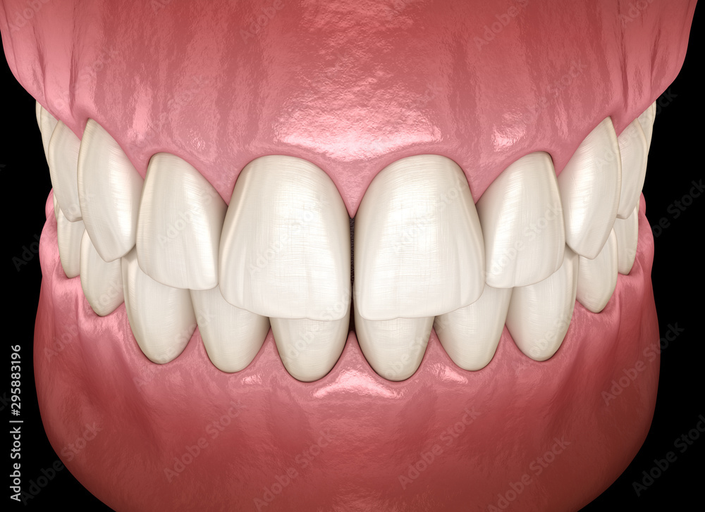 Healthy human teeth with normal occlusion, side view. Medically ...