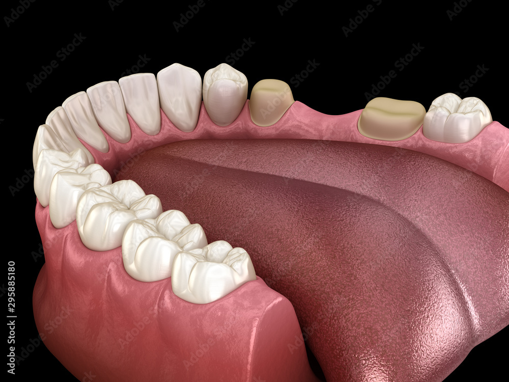 Preparated molar and premolar tooth for dental bridge placement ...