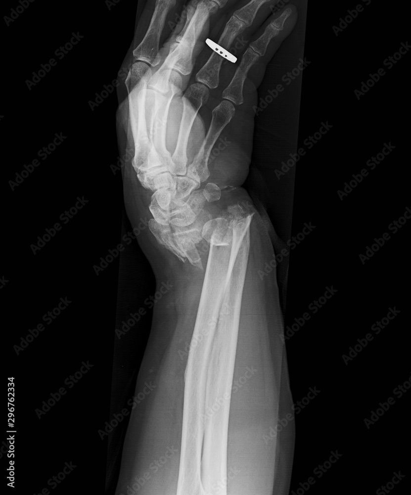 X-ray image of wrist jiont, lateral view, showing distal ulnar and ...
