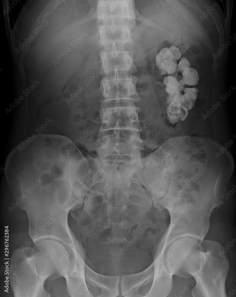 Foto de Stock X-ray image of urinary system (kidney urinary and bladder ...