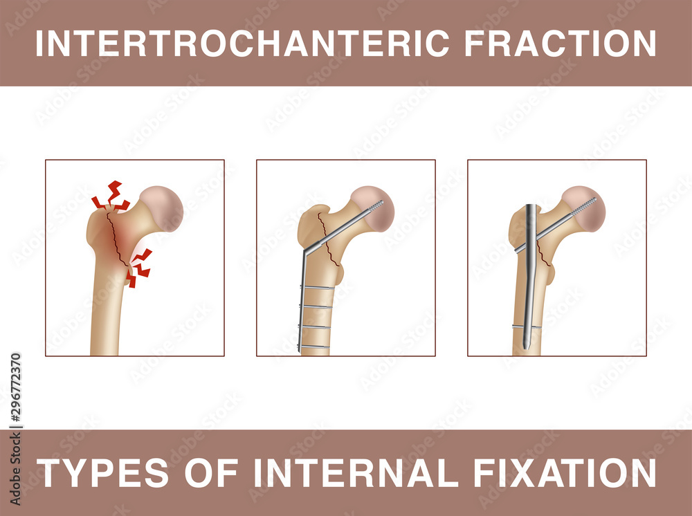 Intertrochanteric fracture. Types of internal fixation. Vector ...