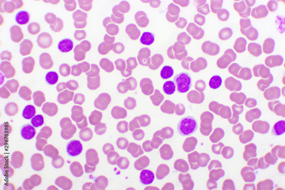 Blood picture of chronic lymphocytic leukemia or CLL, analyze by ...