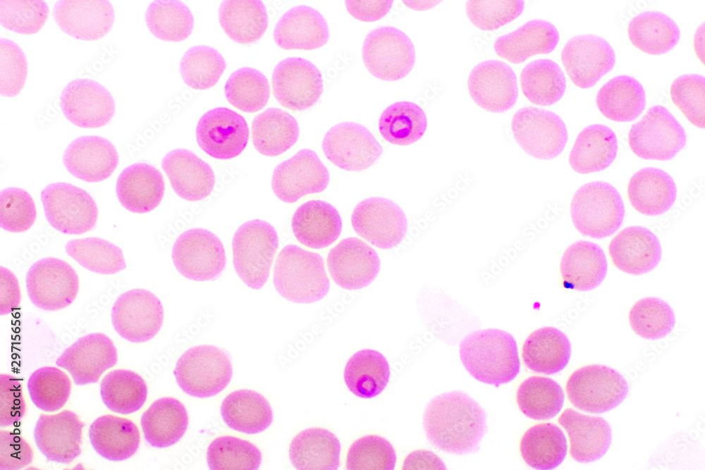 Malaria parasite in red blood cells, ring form stage of Plasmodium ...