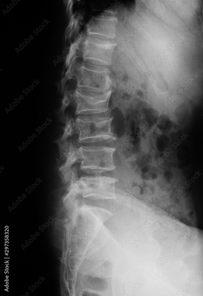 Foto de Stock Thoracolumbar spine (T-L spine) X-ray, lateral vie ...