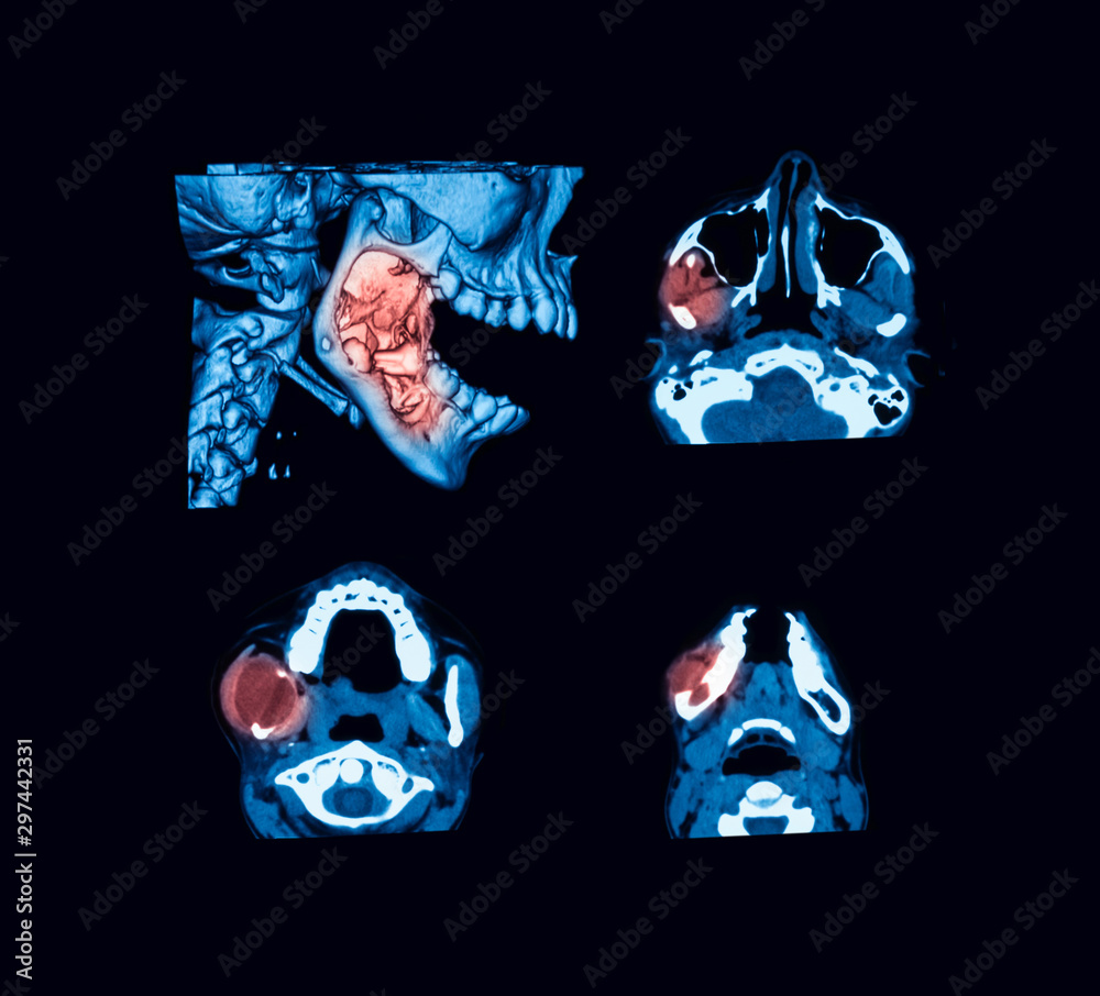 Computed tomography (CT-scan) head, a case of nkeratocystic odontogenic ...