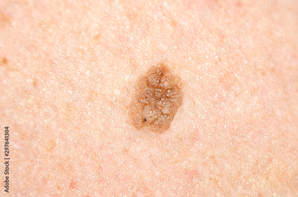Papilloma mole on human skin Stock Photo | Adobe Stock