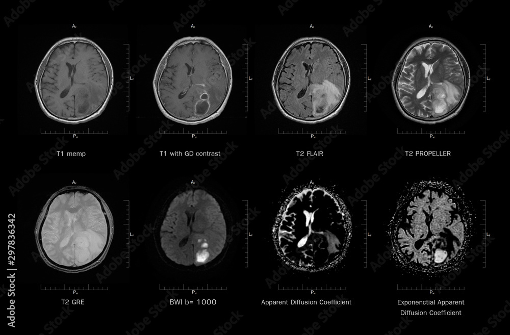 Magnetic resonance imaging (MRI-scan) of brain disease (Stroke), Axial view, の Stock フォト | Adobe ...