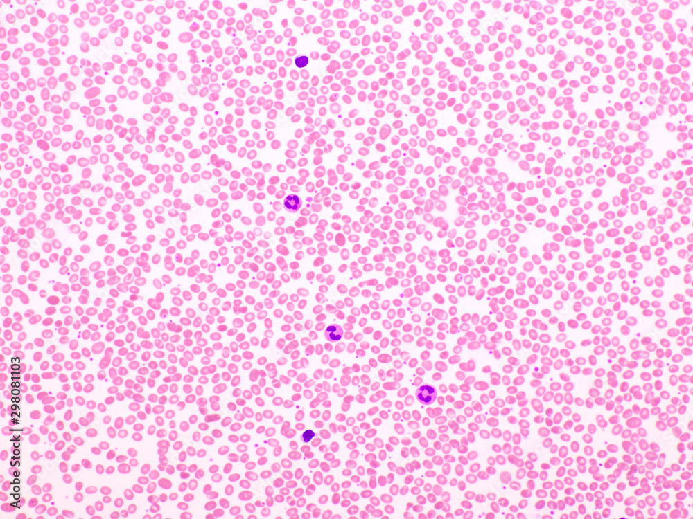 Picture of white blood cell, red blood cell and platelet in blood film ...