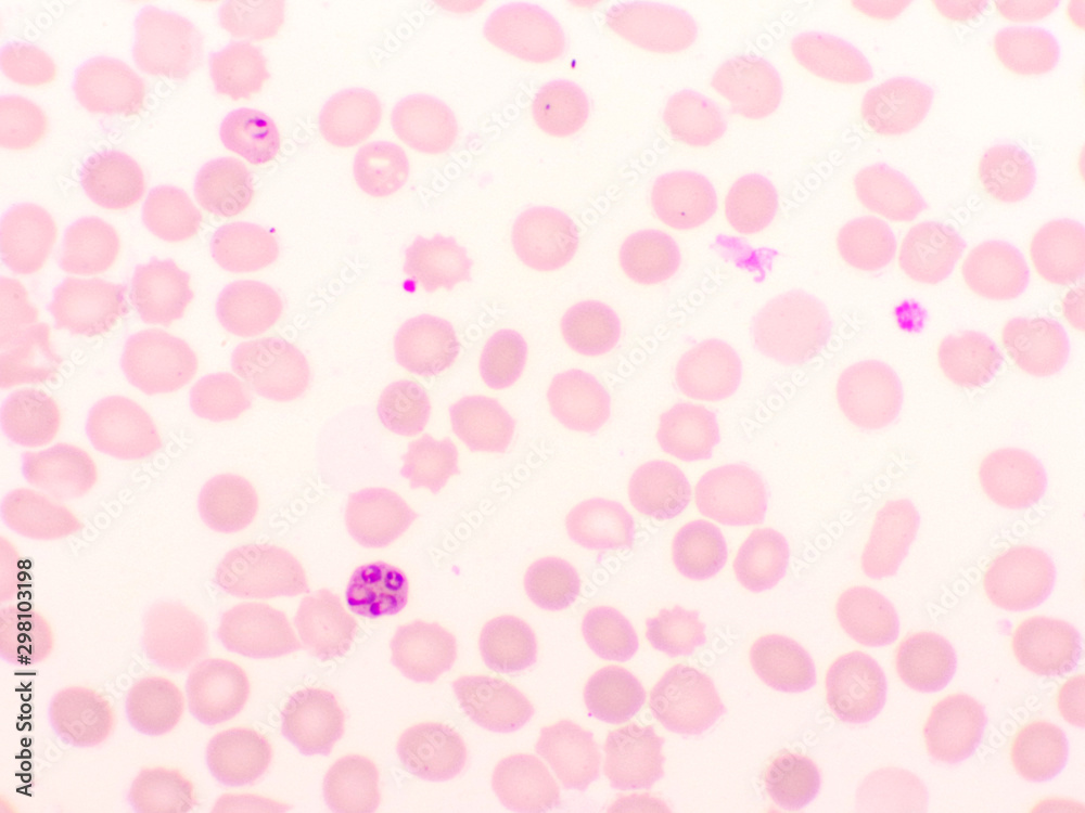 Malaria parasite in red blood cells, ring form stage of Plasmodium ...