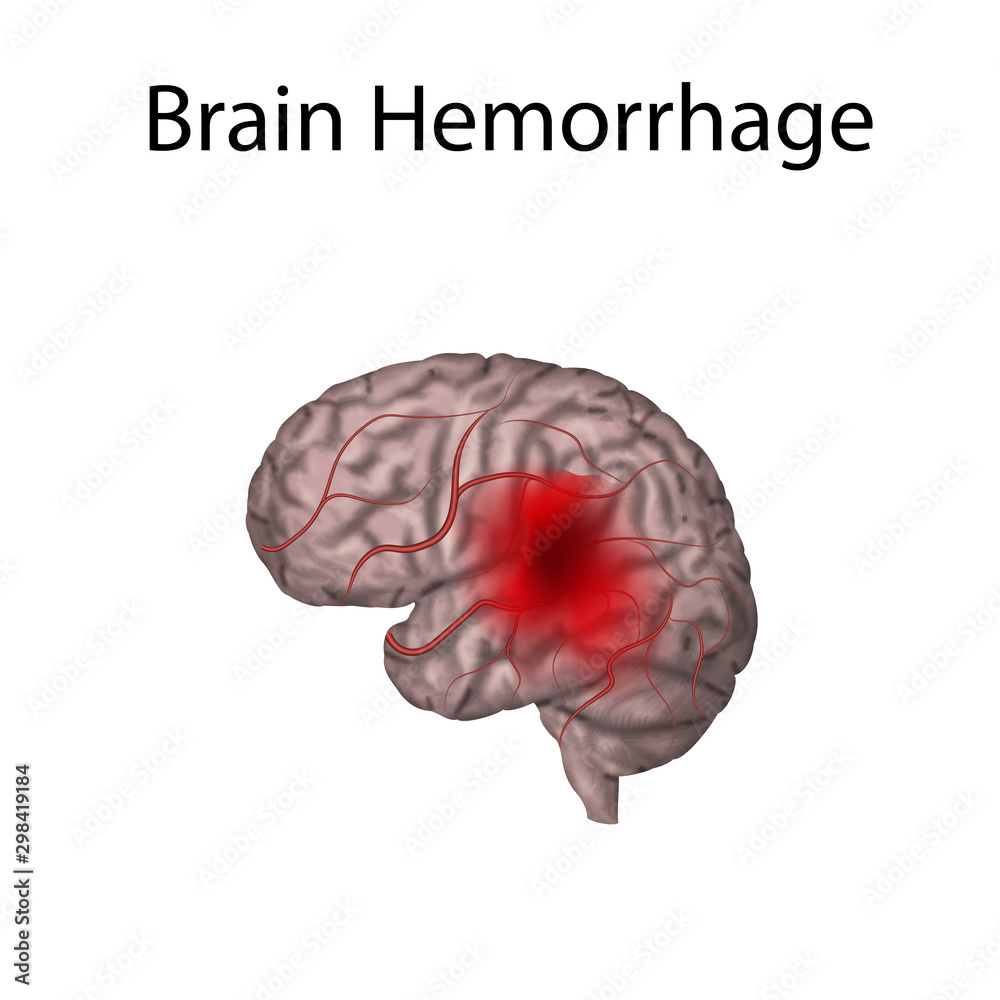 Cerebral, brain hemorrhage. Bleeding. Blood. Medical illustration ...