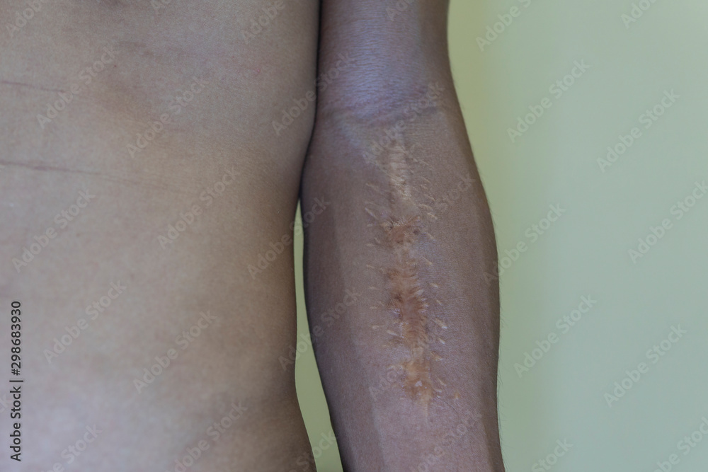 Scars on the skin of the arm after surgery due to an accident in ...