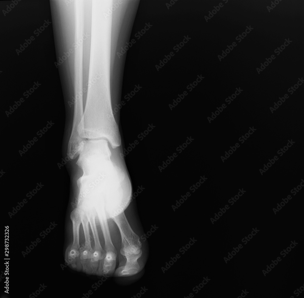 normal radiograph of the ankle joint Stock Photo | Adobe Stock