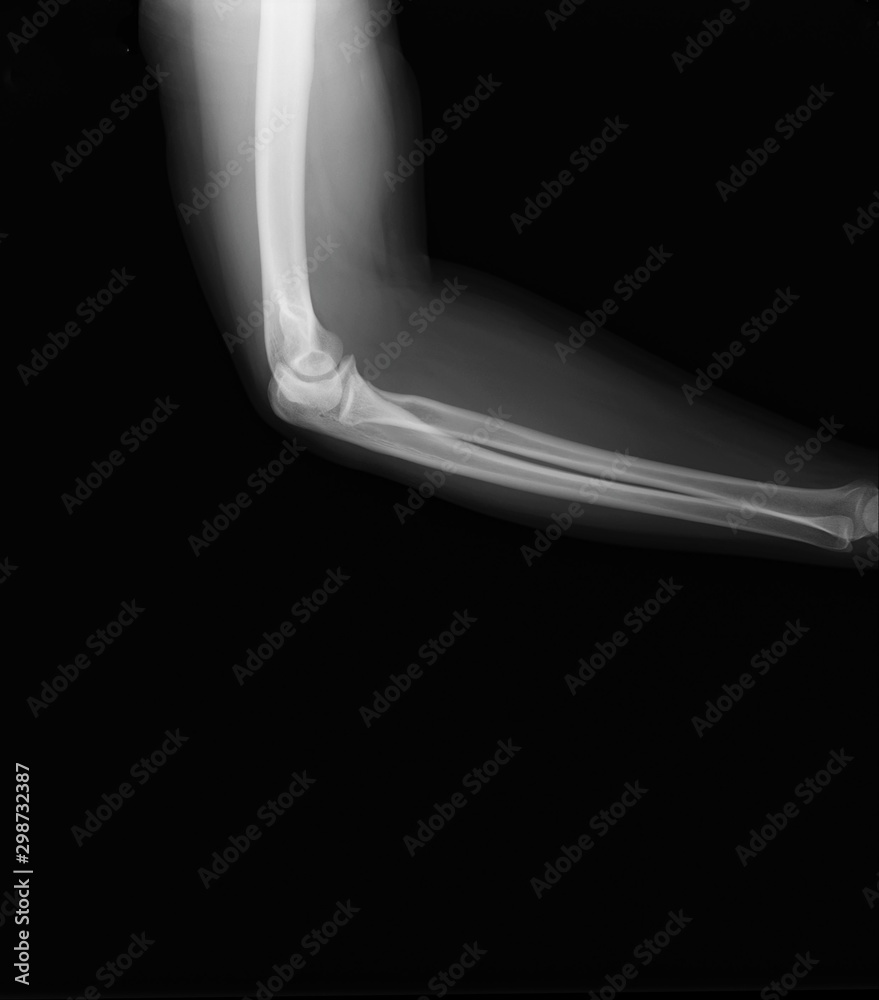 x-ray of the normal elbow joint. traumatology and orthopedics, medical ...