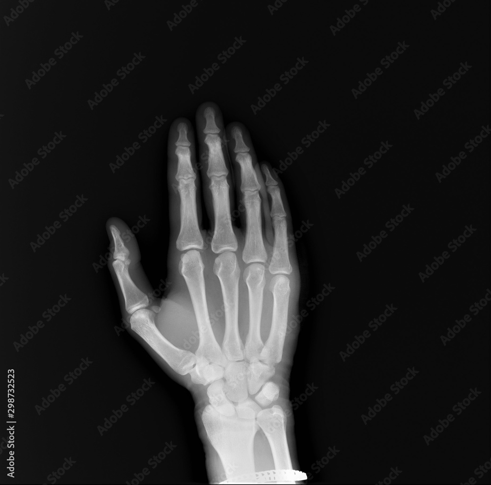 normal x-ray of the hand bones and fingers,orthopedics, medical ...