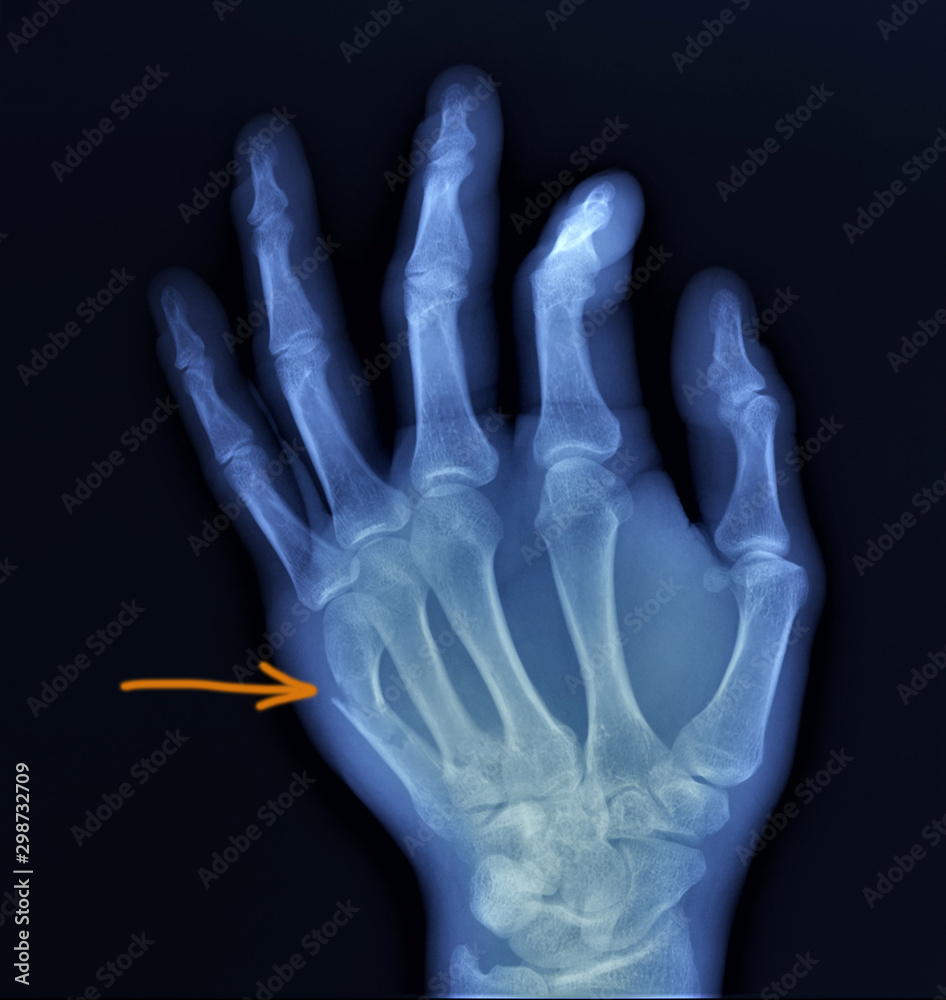 Foto de Stock on the x-ray of the hand fracture of the fifth metacarpal ...