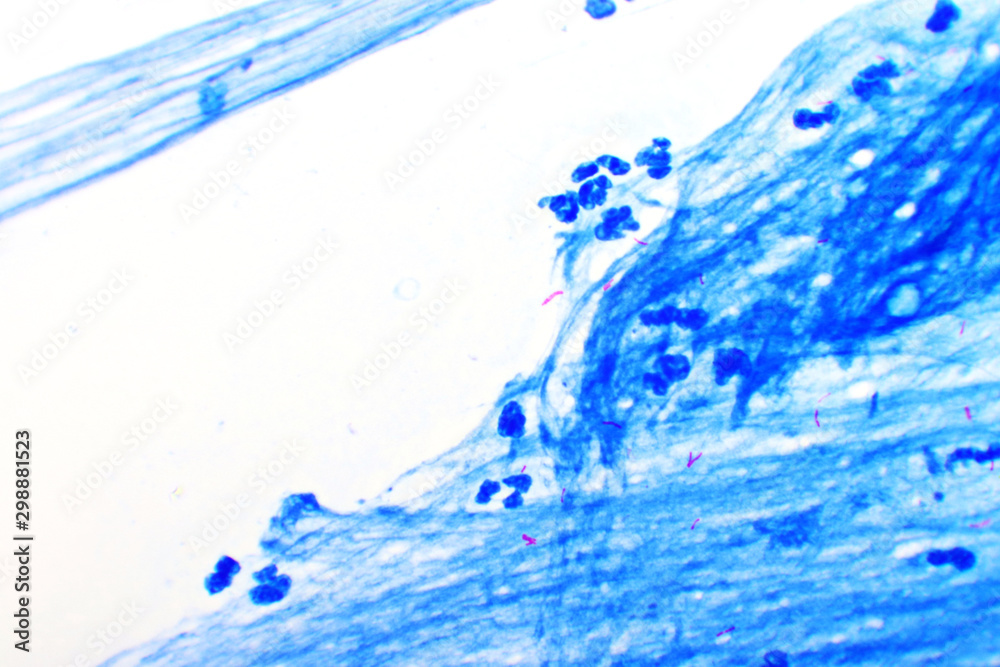 Acid-fast bacilli positive (small red rod) in sputum smear, analyze by ...