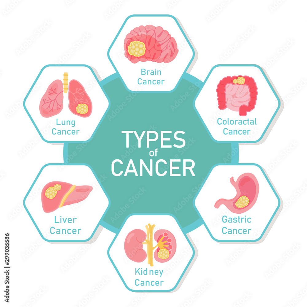 Types of Cancer infographics Vector Illustration. Stock Vector | Adobe ...