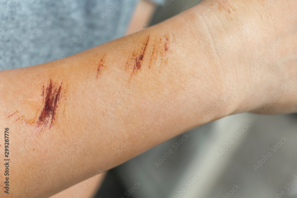 The wound form scabs on hand and arm. The wound happen during woman ...
