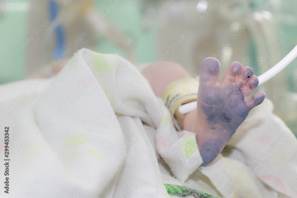 nicu baby, nicu, critically ill, venous, umbilical catheter, catheter ...